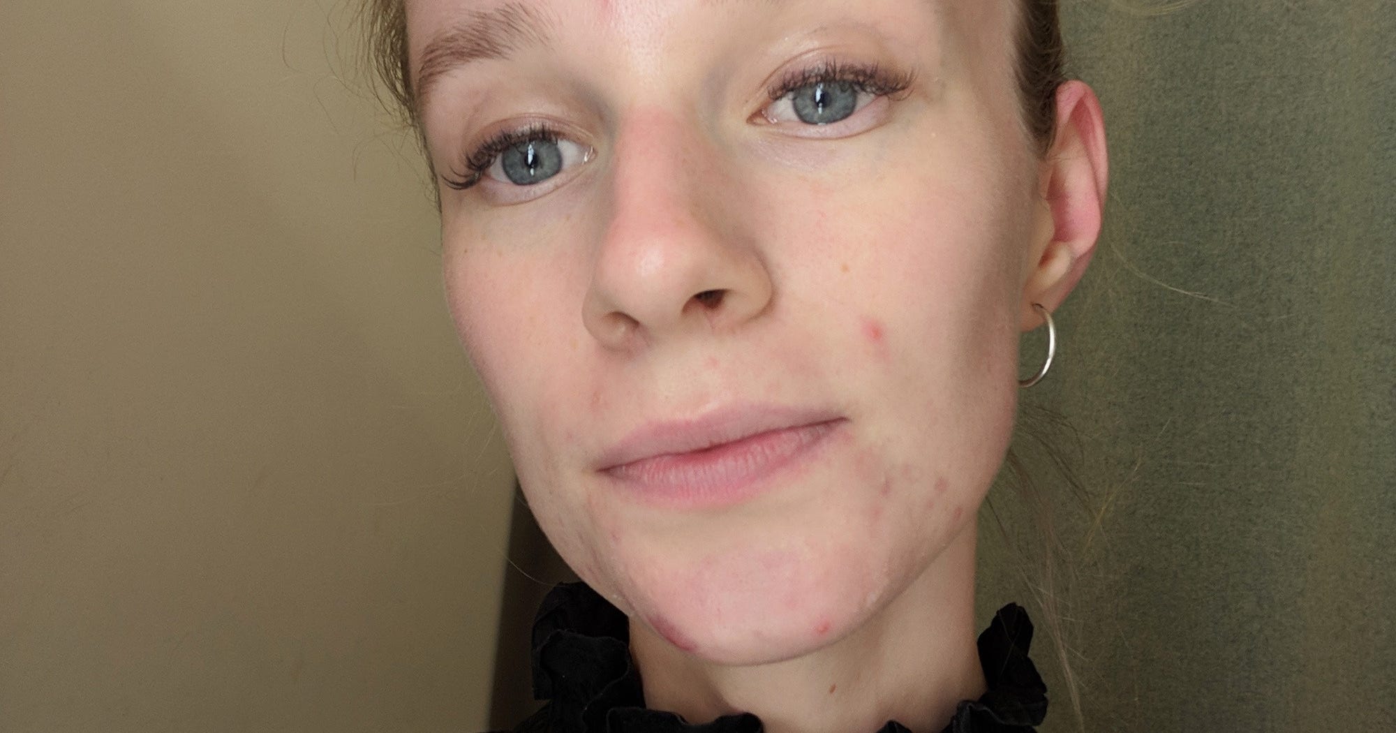 Acne During Your Menstrual Cycle: Real Life Photos