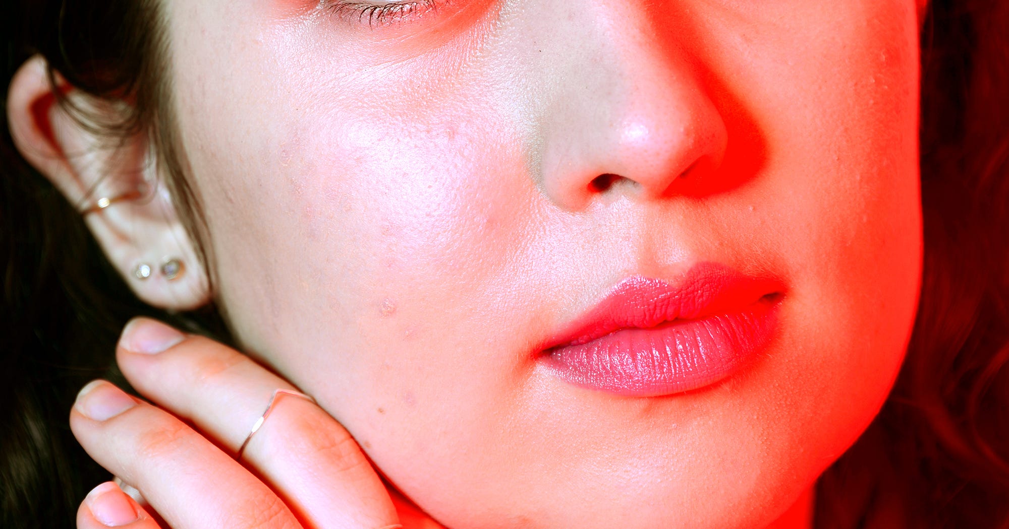 Acne Depression Increased Risk Mental Health Study