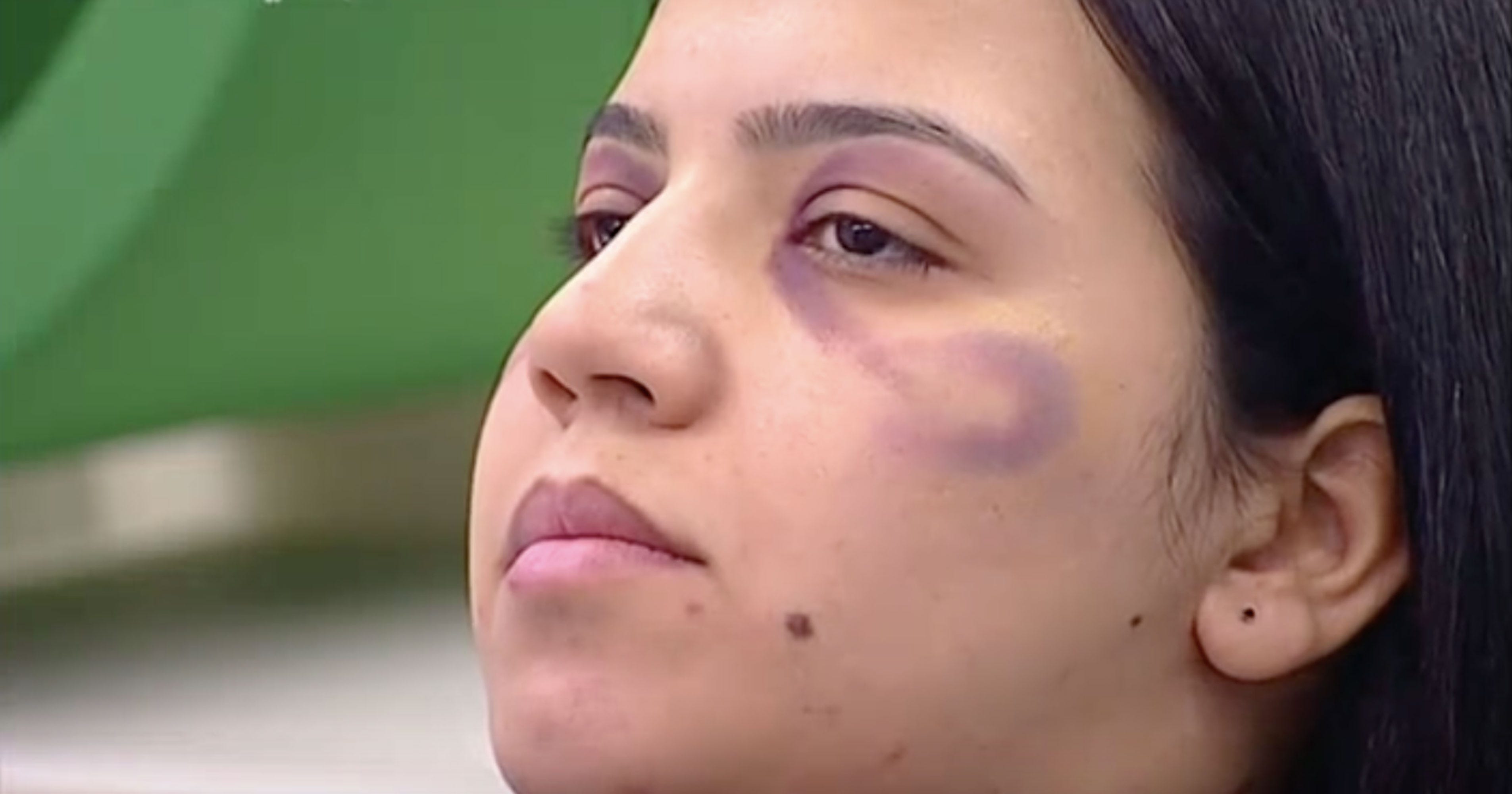 Makeup Tutorial Hide Domestic Violence Bruises Morocco