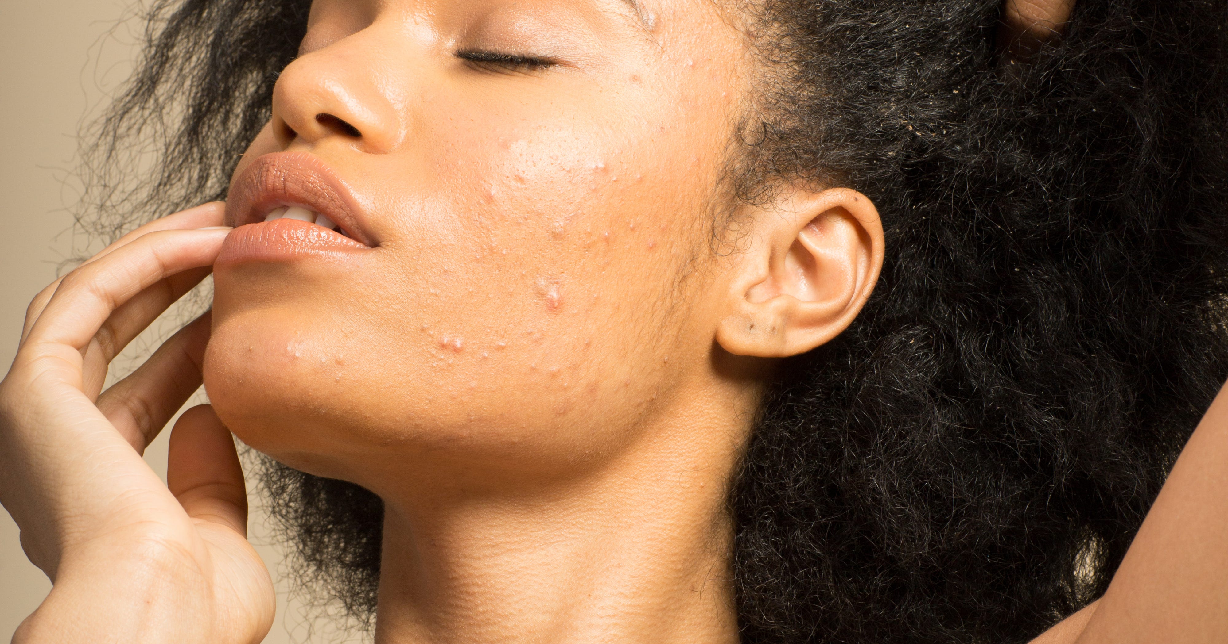 What Is Causing Adult Acne? Link To Mental Health Today