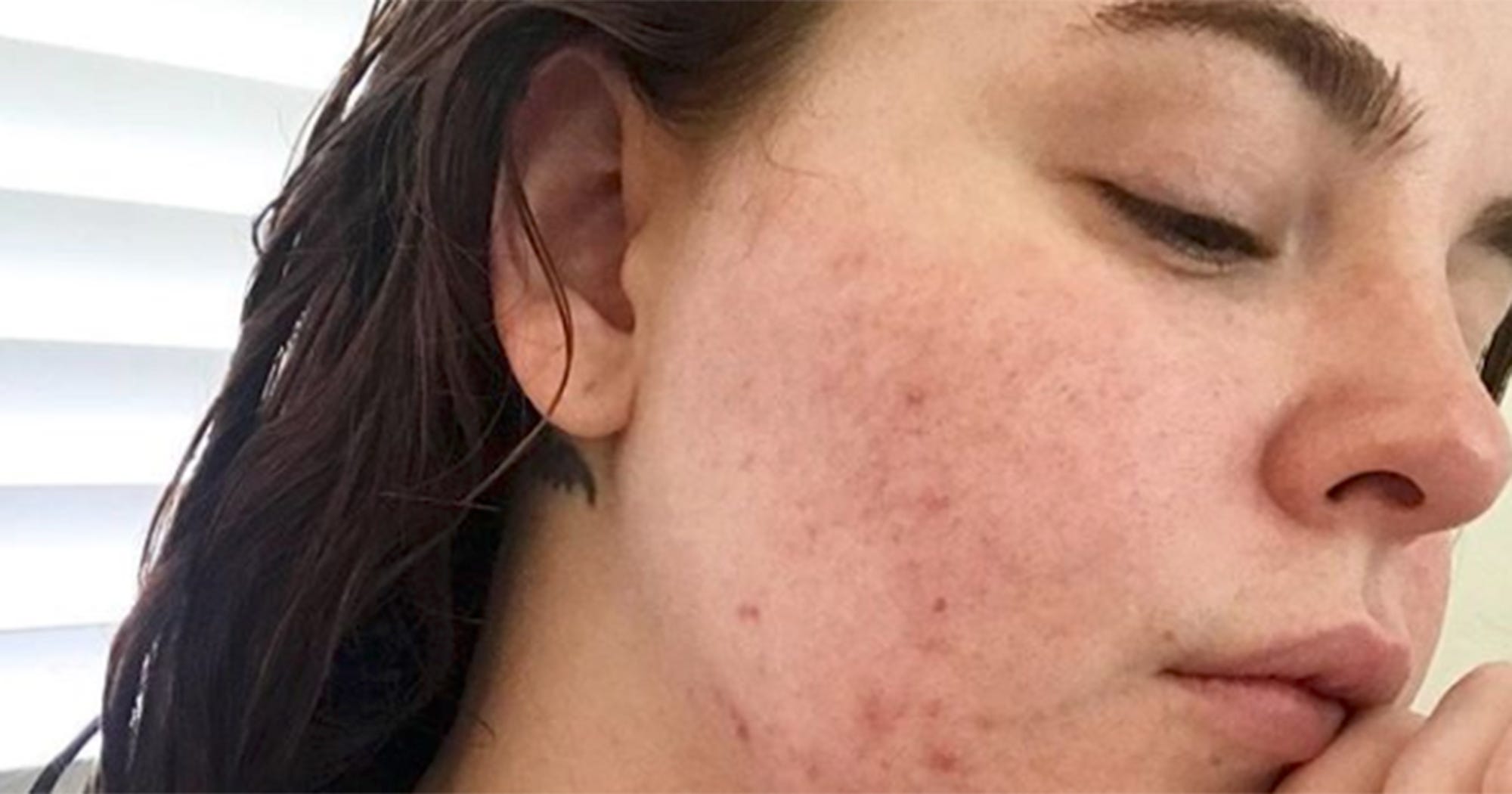 Tess Holliday IUD Acne Skin Irritation Instagram